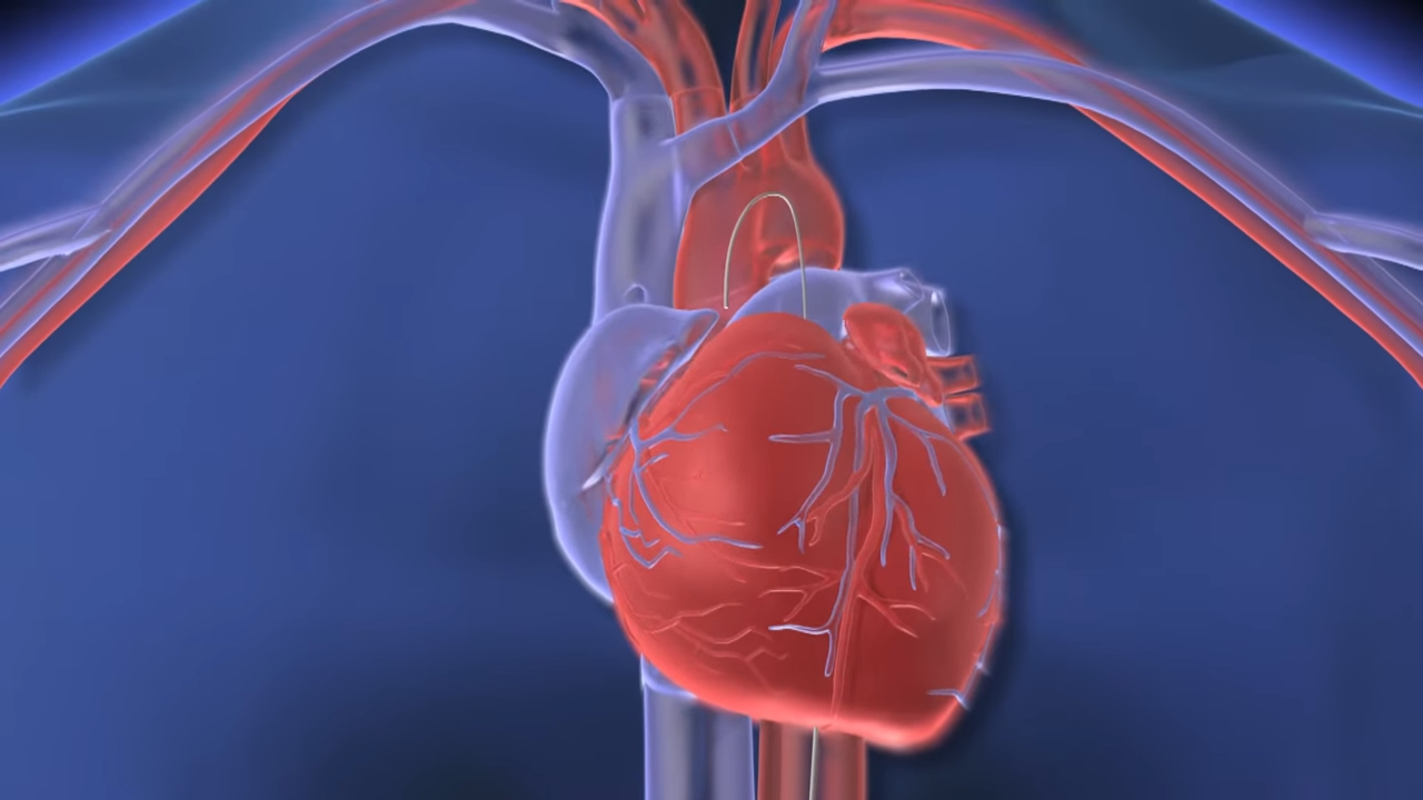 What Is the Risk of Death from an Angiogram Procedure?